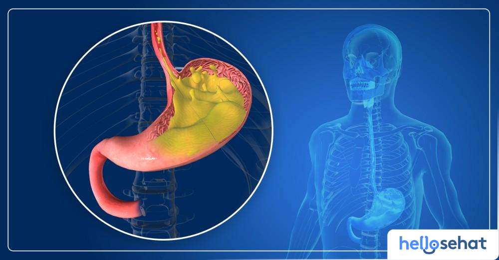 Heartburn: Gejala, Penyebab, Pengobatan, dll. - Hello Sehat