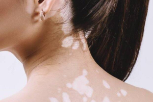 Vitiligo: Gejala, Penyebab, Pengobatan, dll - Hello Sehat
