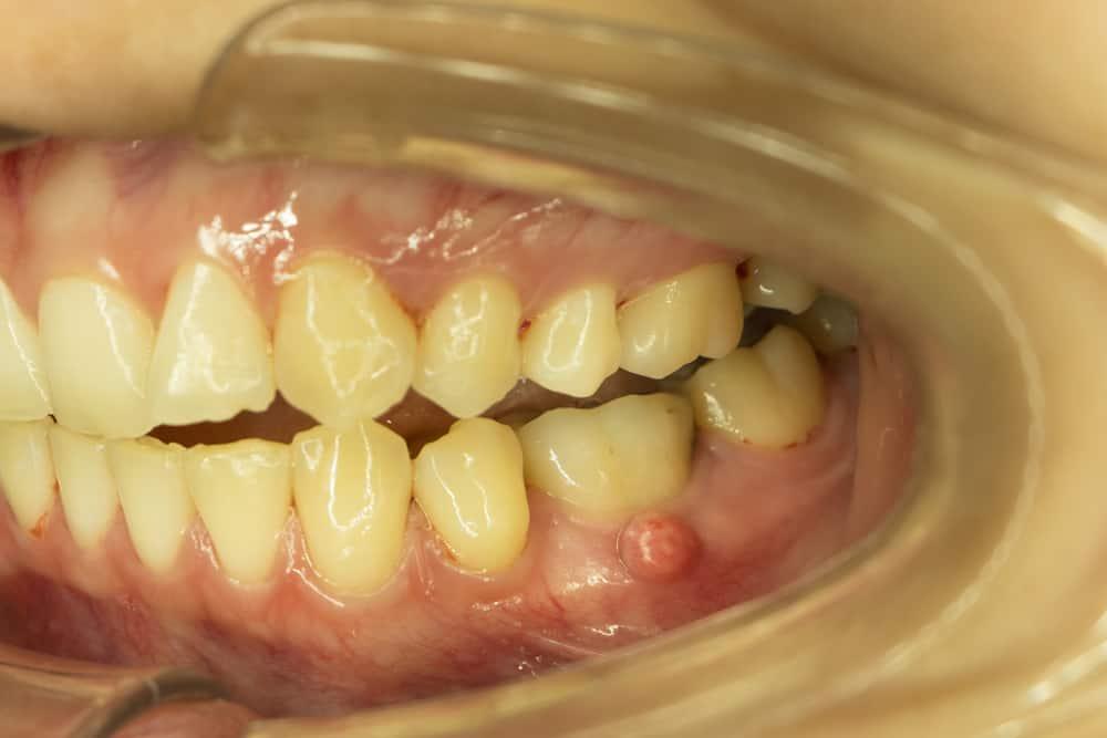 Abses Gigi: Obat, Penyebab, Gejala, dll. - Hello Sehat