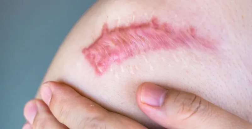 5 Jaringan Parut pada Kulit dan Cara Mengatasinya - Hello Sehat