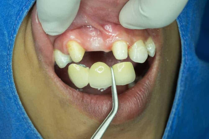 Dental Bridge: Definisi, Manfaat, Prosedur, dan Perawatan