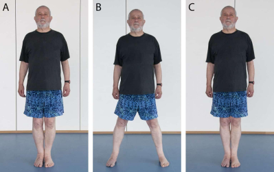 Mengenal Tes Romberg, Pemeriksaan Keseimbangan Tubuh