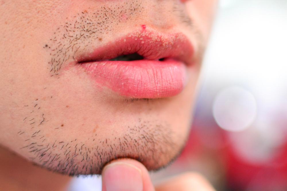 Fordyce Spot: Gejala, Penyebab, dan Pengobatan