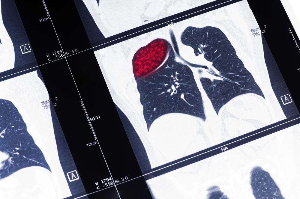 Tumor Paru: Gejala, Penyebab, Diagnosis, Pengobatan - Hello Sehat
