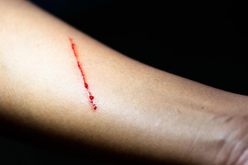 4 Langkah Pertolongan Pertama pada Luka Sayat | Hello Sehat