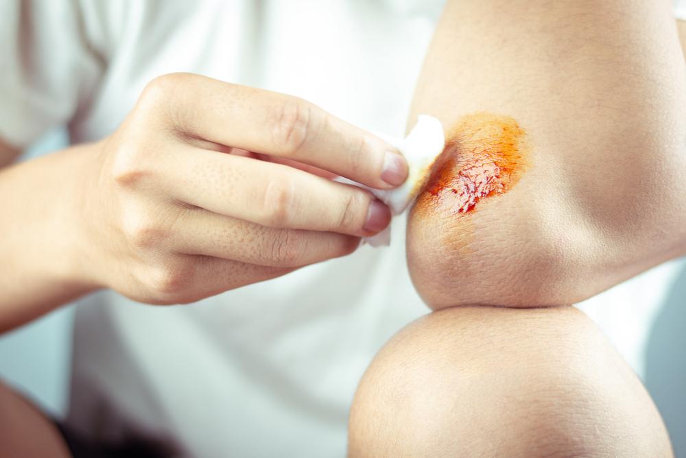 Cara Membersihkan Luka yang Benar dan Aman Secara Medis