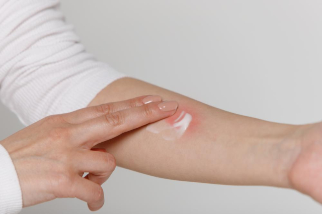 Desoximetasone: Kegunaan, Dosis, Efek Samping - Hello Sehat