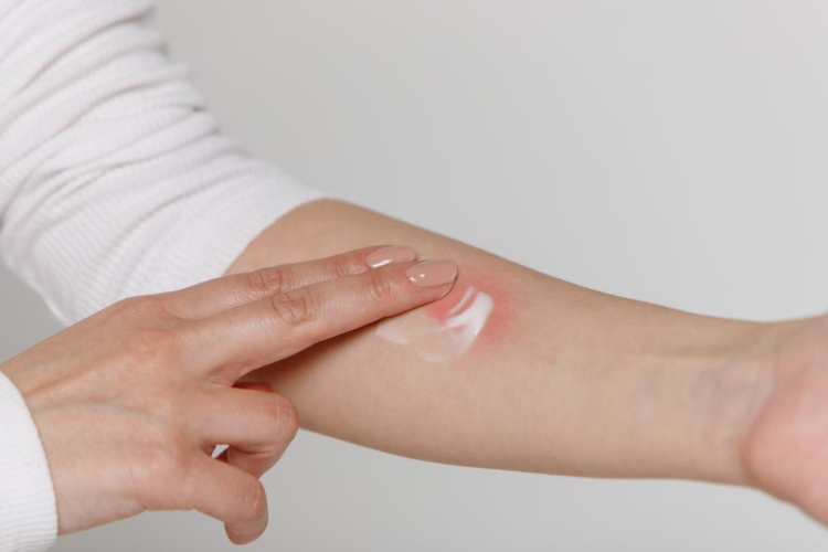 Desoximetasone: Kegunaan, Dosis, Efek Samping - Hello Sehat