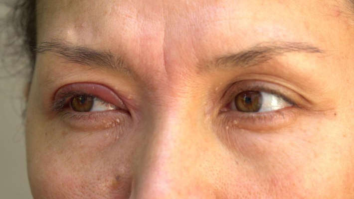 Bacitracin: Kegunaan, Dosis, Efek Samping - Hello Sehat