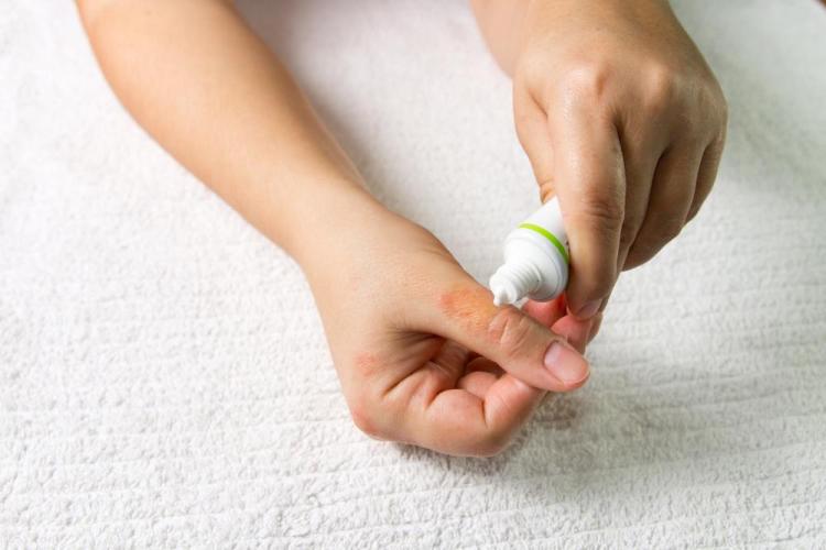 Dithranol • Hello Sehat