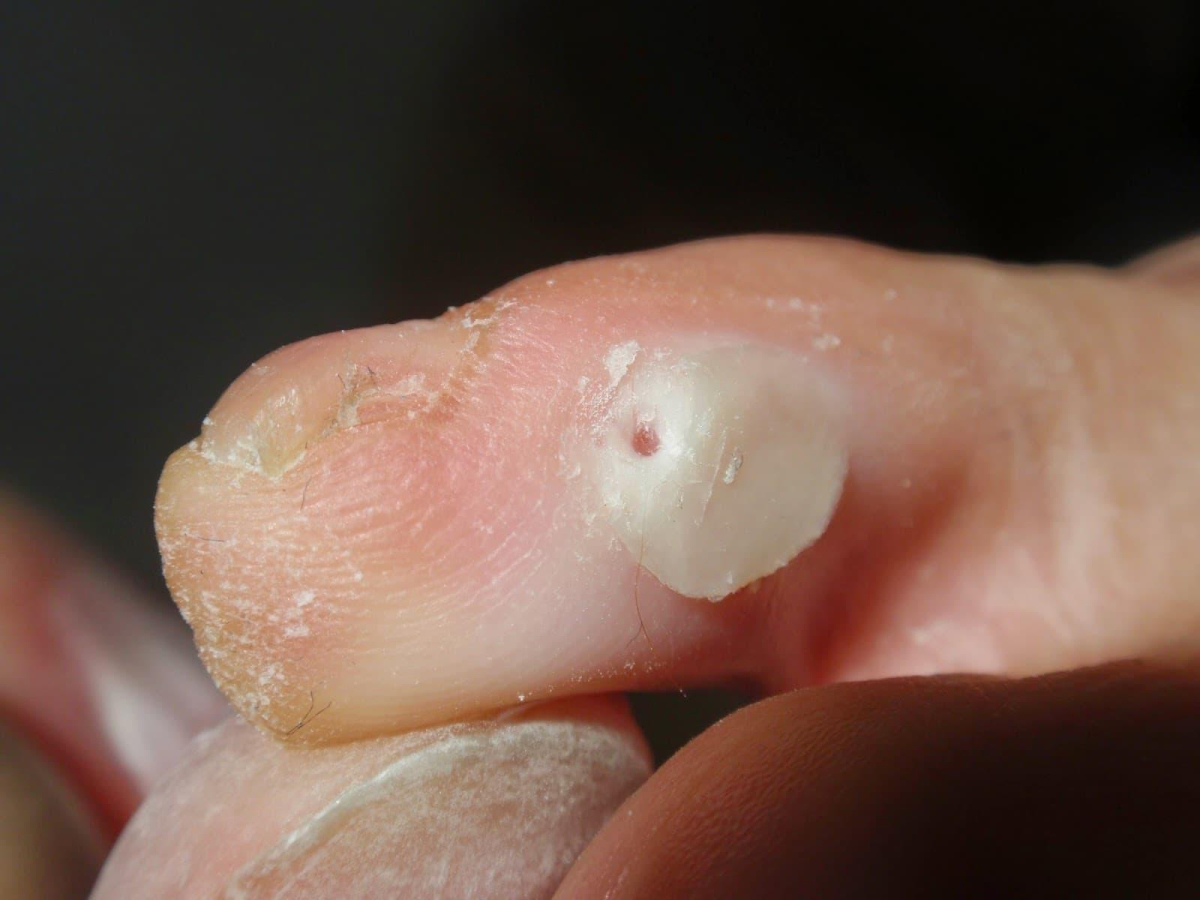 Heloma: Pengertian, Gejala, Penyebab, dan Pengobatan