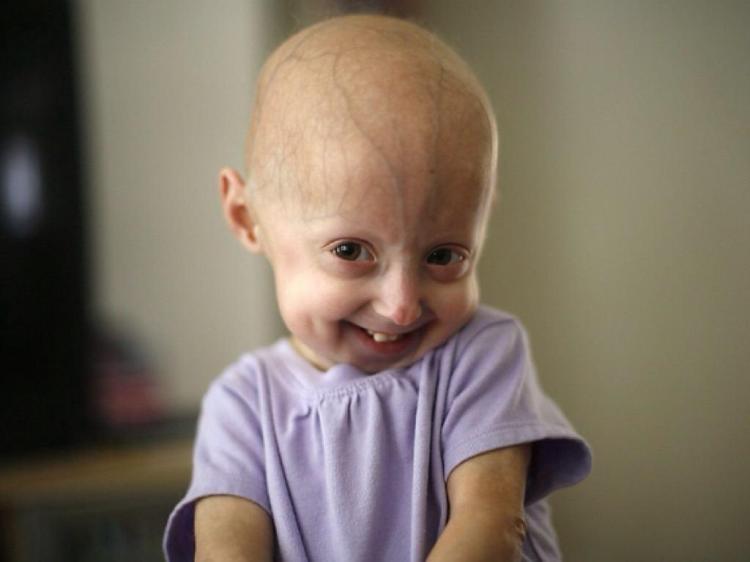 Progeria: Gejala, Penyebab, Pengobatan, dll. - Hello Sehat