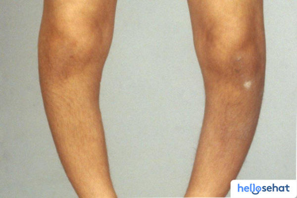 Rakitis: Gejala, Penyebab, dan Cara Mengobati - Hello Sehat