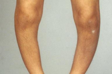 Rakitis: Gejala, Penyebab, dan Cara Mengobati - Hello Sehat