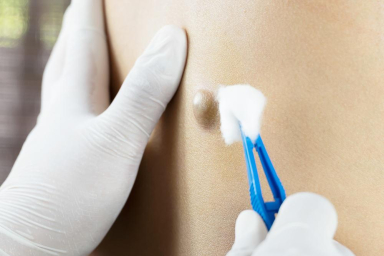 Kista: Gejala, Penyebab, Pengobatan, dll. - Hello Sehat