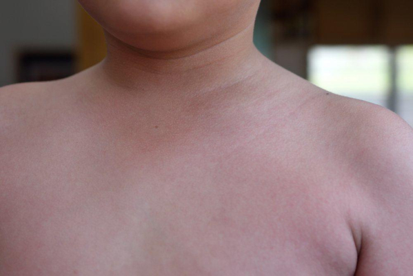 Scarlet Fever: Gejala, Penyebab, Obat, dll - Hello Sehat