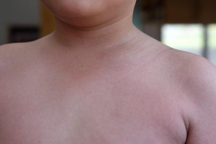 Scarlet Fever: Gejala, Penyebab, Obat, dll - Hello Sehat