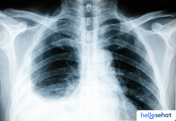 Pleuritis: Gejala, Penyebab, Komplikasi, Hingga Pengobatan