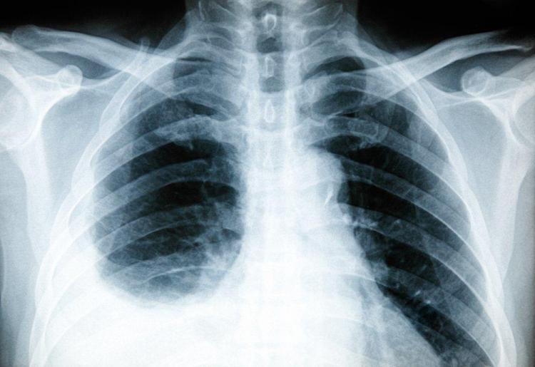 Pleuritis: Gejala, Penyebab, Komplikasi, Hingga Pengobatan