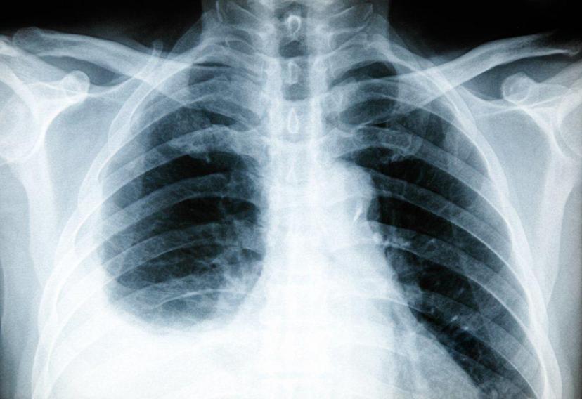 Pleuritis: Gejala, Penyebab, Komplikasi, Hingga Pengobatan