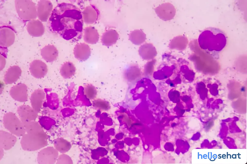 Sepsis: Gejala, Penyebab, dan Pengobatan - Hello Sehat