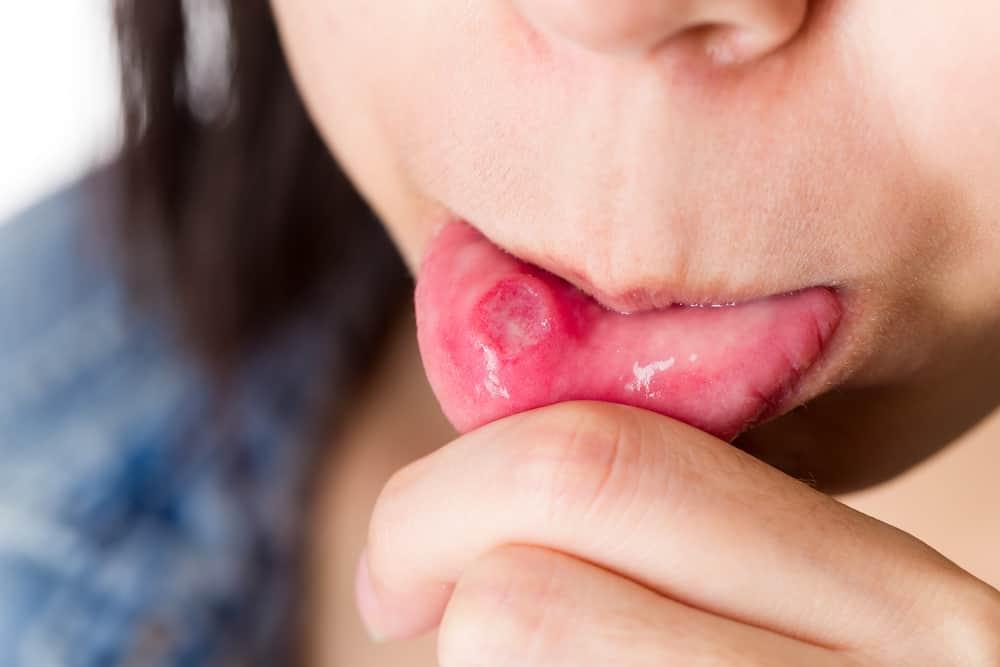 Stomatitis: Gejala, Penyebab, Pengobatan, dll. - Hello Sehat