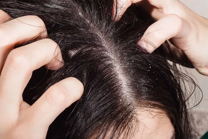 Macam-Macam Dermatitis yang Perlu Diketahui, Apa Perbedaannya?
