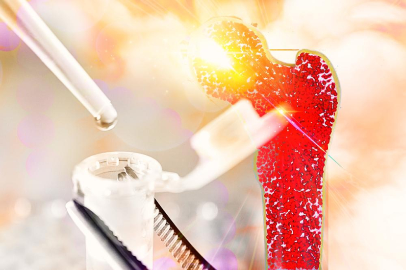 Bone Marrow Puncture: Definisi, Prosedur, dan Komplikasinya • Hello Sehat