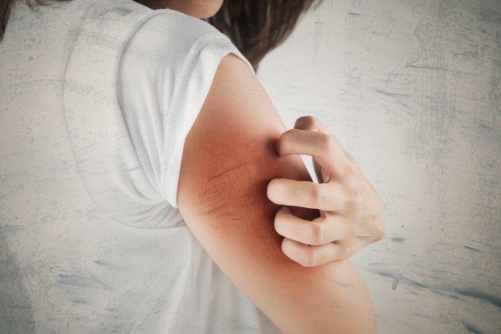 Eksim (Dermatitis Atopik): Gejala, Penyebab, dan Pengobatan