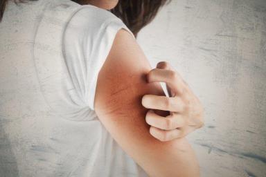 Eksim (Dermatitis Atopik): Gejala, Penyebab, dan Pengobatan