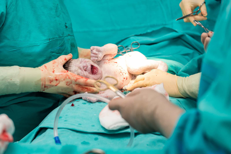 Proses Melahirkan Caesar: dari Persiapan hingga Pemulihan