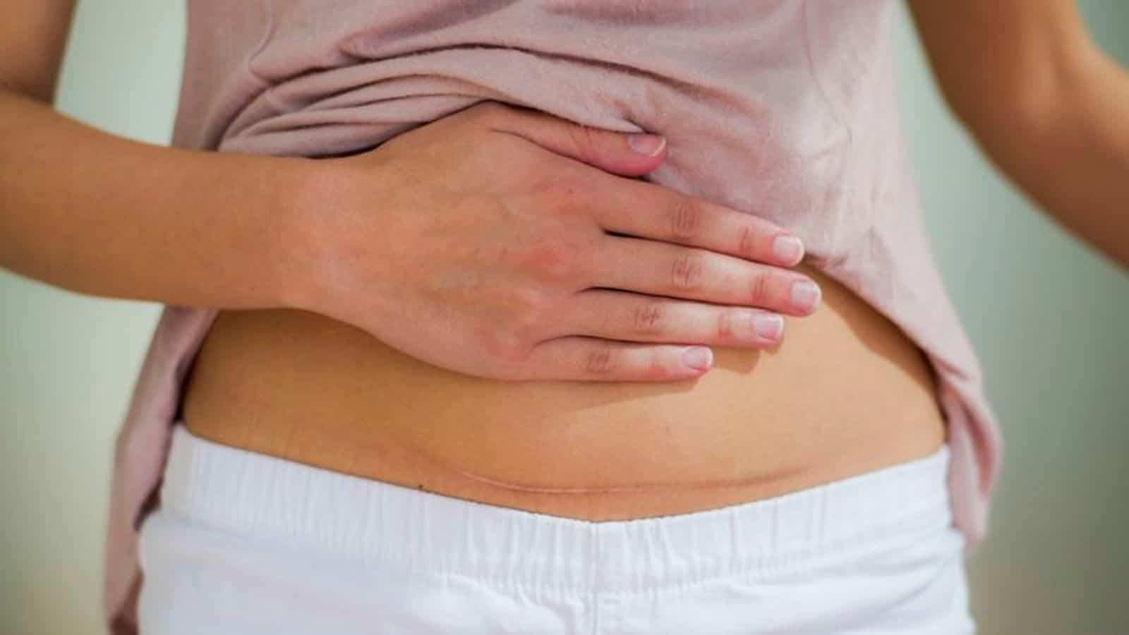 Perawatan Luka Post SC (Operasi Caesar) agar Cepat Pulih