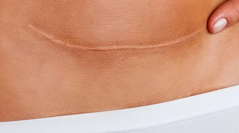 Perawatan Luka Post SC (Operasi Caesar) agar Cepat Pulih