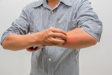 Obat dan Perawatan Mengatasi Alergi Kulit | Hello Sehat