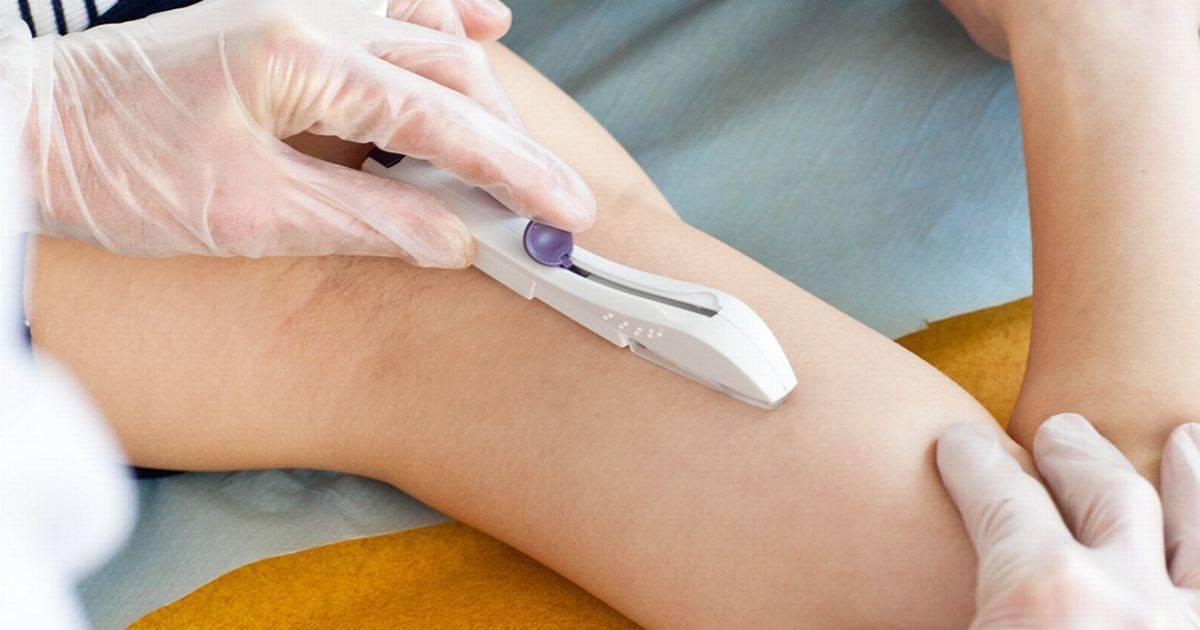 KB Implan: Cara Kerja, Prosedur Pemasangan, dan Risiko