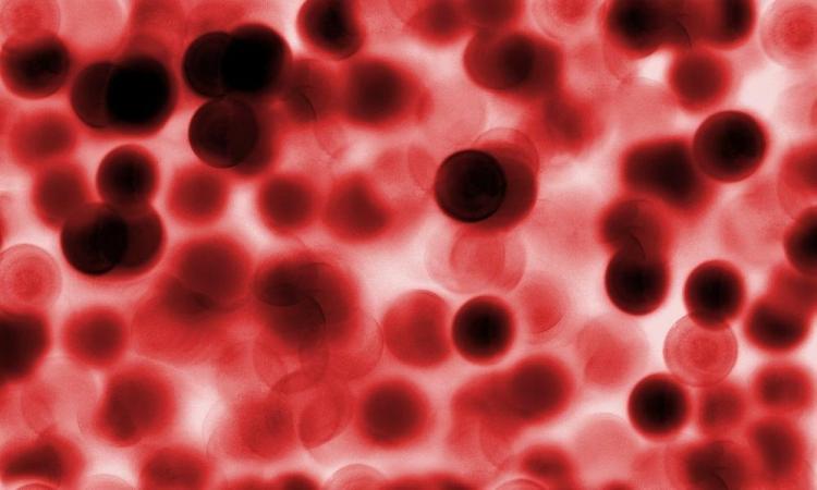 Gejala Leukemia pada Orang Dewasa - Hello Sehat