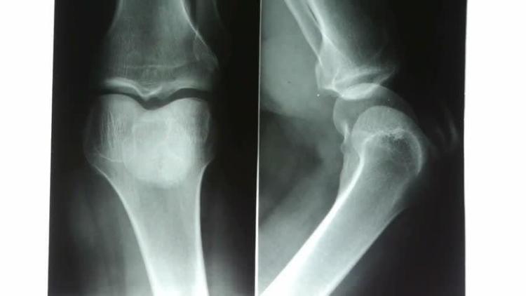 TBC Tulang: Gejala, Penyebab, Pengobatan, dll. - Hello Sehat