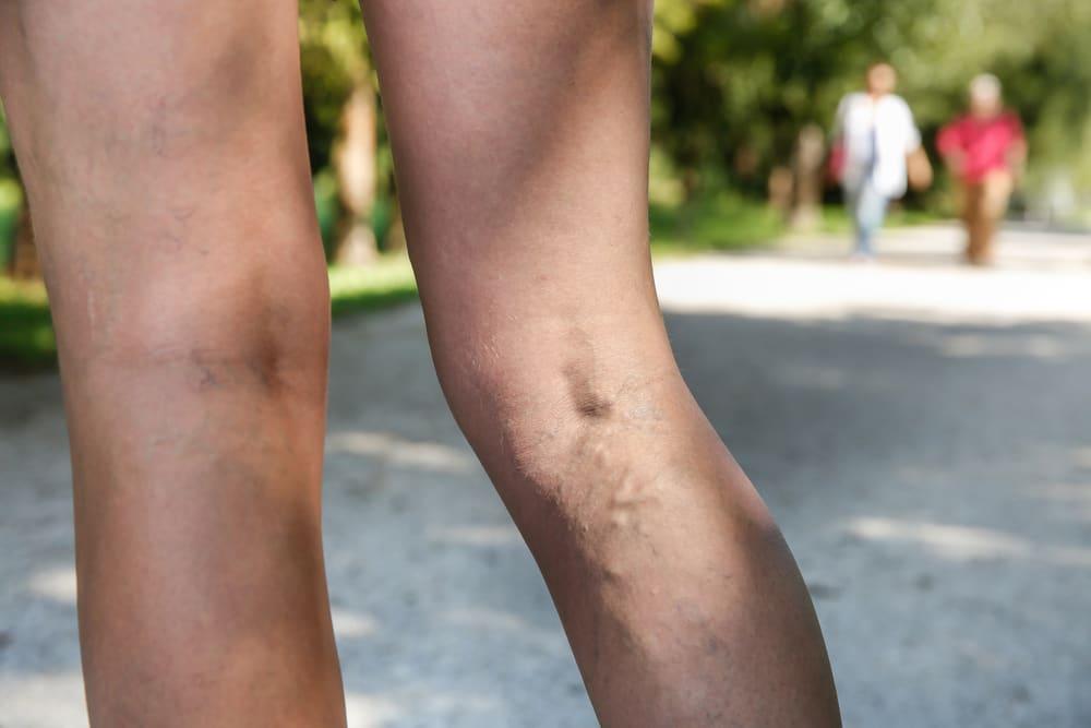 Penyebab Varises di Kaki dan Beragam Faktor Risikonya