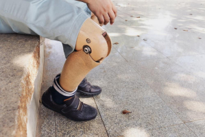 Serba-serbi Prostesis, Alat Buatan Pengganti Anggota Tubuh