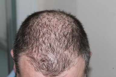 9 Penyebab Rambut Botak di Usia Muda dan Pengobatannya