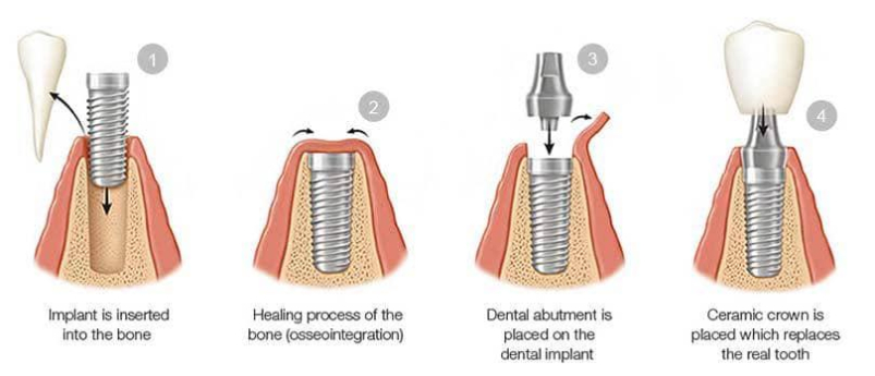 Mengenal Prosedur Implan Gigi, Apa Kelebihannya? - Hello Sehat