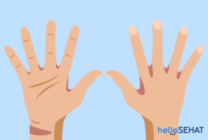 Penyakit Kulit Menular: Jenis yang Sering Terjadi di Indonesia