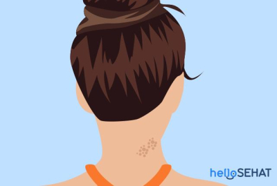 Apa Bedanya Tahi Lalat dan Skin Tag (Acrochordon)?