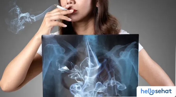 Bronkitis Kronis dan Emfisema, Apa Perbedaannya?