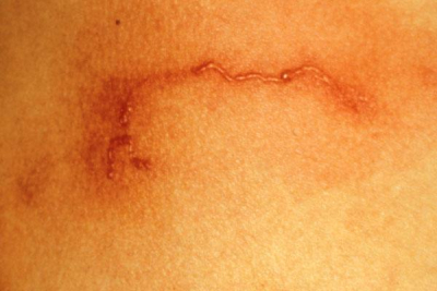 5 Penyebab Ruam di Pergelangan Tangan Dari Alergi Hingga Eksim