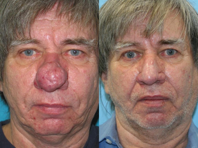 Rinofima Adalah Penyebab Pria Punya Hidung Jambu (Benar Bawa Hoki?)