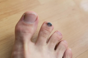 Kuku Kaki Hitam, Ini 5 Penyebab dan Cara Mengobatinya