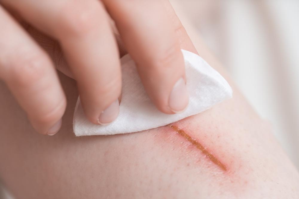 Selulitis: Gejala, Penyebab, dan Pengobatannya - Hello Sehat