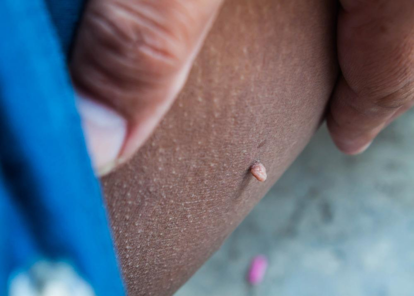 Skin Tag (Daging Tumbuh): Gejala, Penyebab, dll. - Hello Sehat