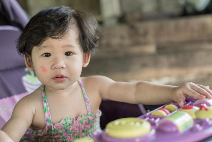 Pityriasis Alba: Obat, Gejala, Penyebab, dll. • Hello Sehat